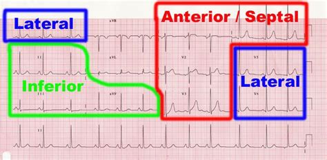 Heart Walls On Ekg Clinical Ecg Ekg Interpretation Basics How To Read Mi