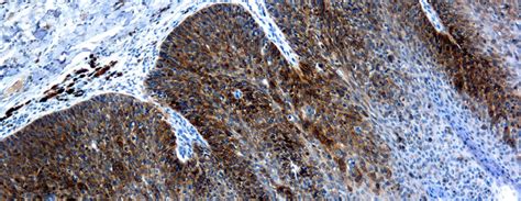 곤지름 성기사마귀 Elclinic1