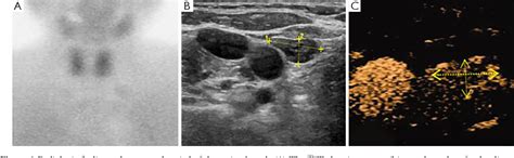 Figure 1 From Microwave Ablation Of Ectopic Parathyroid Adenoma In The Carotid Sheath With