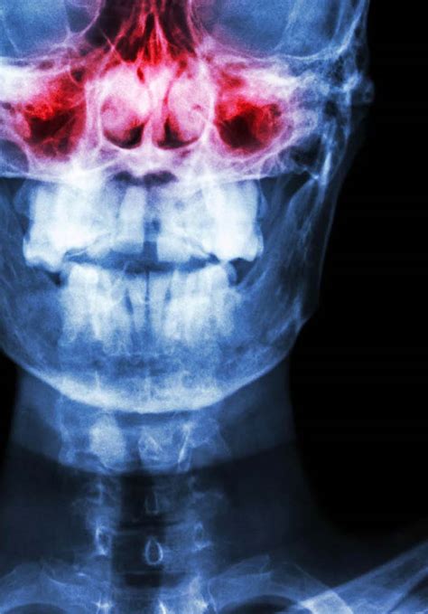 Acute Sinusitis X Ray