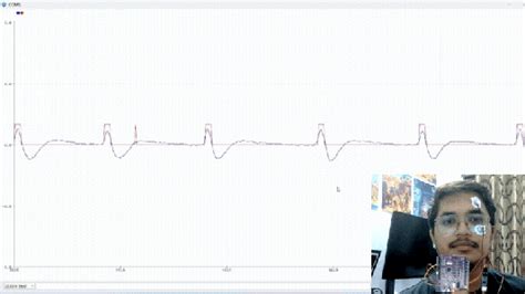 Eye Blink Detection By Recording Eog Using Bioamp Exg Pill 8 Steps Instructables