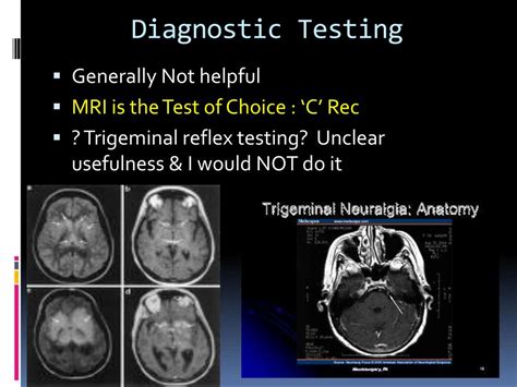 PPT Trigeminal Neuralgia PowerPoint Presentation Free Download ID