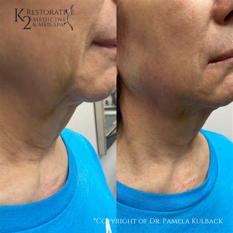 Mono Threading Before And After At Catherine Fletcher Blog