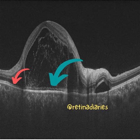 Bacillary Layer Ophthalmology Notes And Synopses