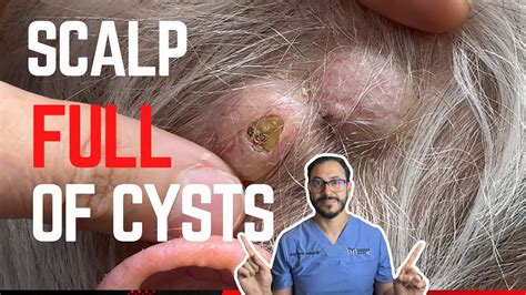 Scalp Full Of Cysts Pilar Cysts And Melanoma Youtube