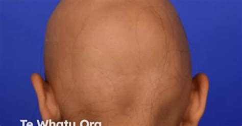 Alopecia Totalis Image