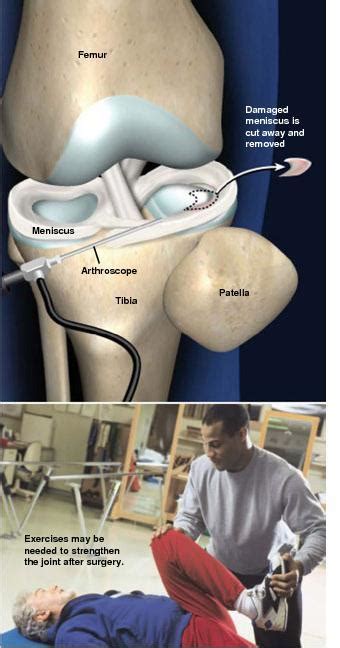 Partial Meniscectomy Sarasota Fl Schofield Hand And Bright