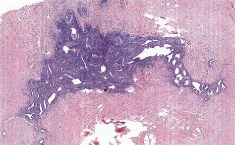 Pathology Outlines Acute Appendicitis
