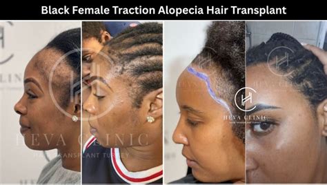 Hair Transplant For Traction Alopecia In Turkey Does It Work Heva