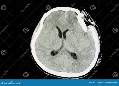 Compression Fracture Of A Skull Stock Image Image Of Human Emergency 115414753