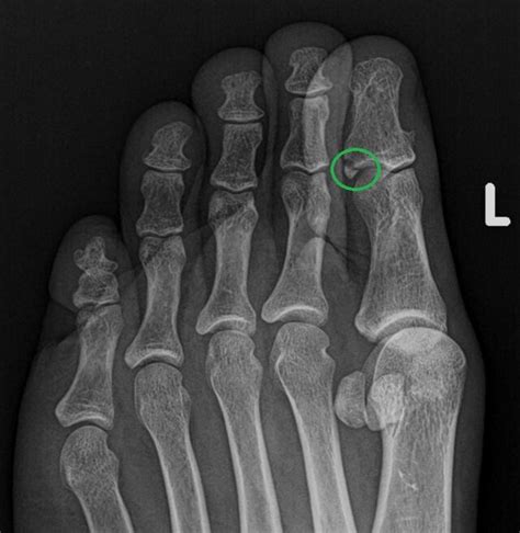 Radiopaedia Case Fracture Distal Phalanx Of Great Toe Id 62584 Study