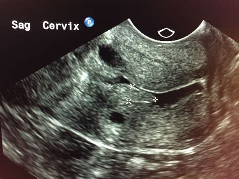 Cervical Polyps Ultrasound