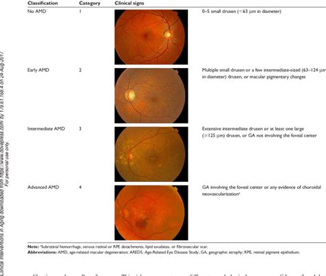 Demonstration Of The Classification Of Amd According To Areds Download Table Demonstration Of The Classification Of Amd According To Areds Download Table