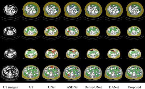 Illustration Of Sat And Vat Segmentation Resulted From Different