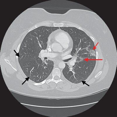 Computed Tomography Pulmonary Angiogram Shows Treeinbud Opacities Download Scientific Diagram