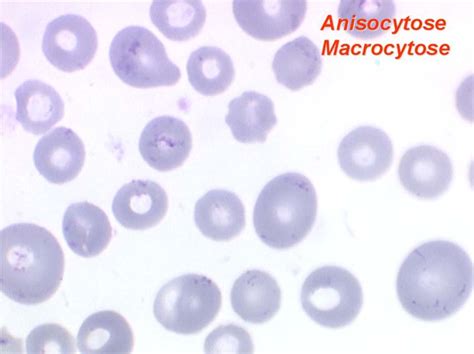 Cytologie Des Anémies