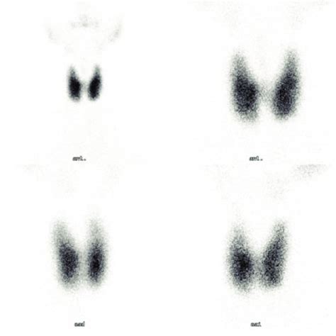 It Is Noted A Diffuse Enlargement Of Thyroid With A Homogeneous Download Scientific Diagram