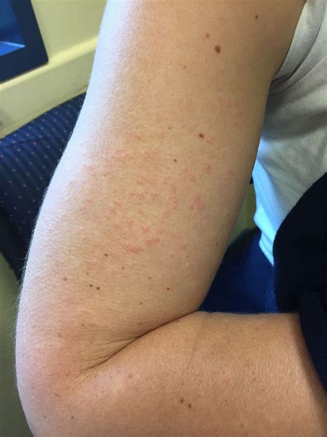 Roseola Rash Adults