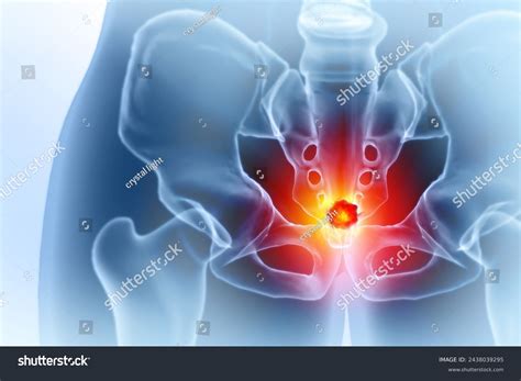 Pelvic Bone Cancer Tumor 3d Illustration Stock Illustration 2438039295