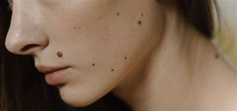 Punch Biopsy Procedure In Cambridge The Day Clinic