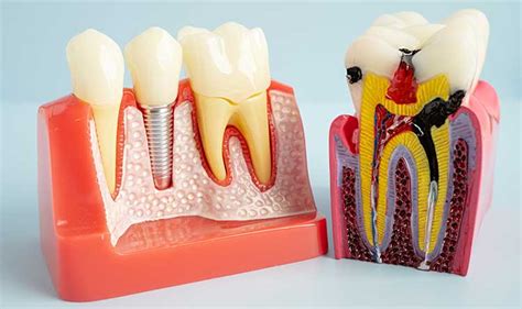 Caries De Raíz O Radicular Causas Y Tratamientos • Dentistas Toledo
