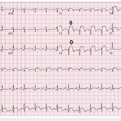 Ecg Showing St Segment Elevations In The Anterior And Inferior Leads
