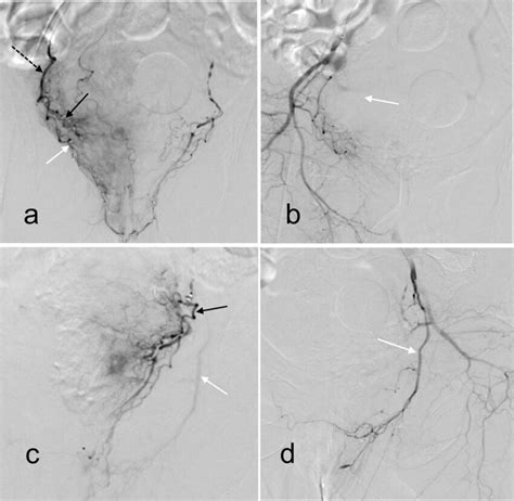 Imaging Of Bilateral Prostatic Artery Embolism A Both The Right Download Scientific Diagram
