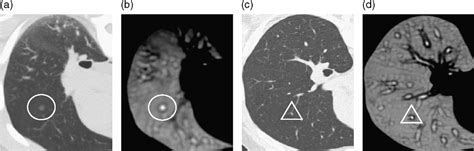 Figure 1 From Automated Detection Of Lung Nodules In Ct Images Using Shape Based Genetic