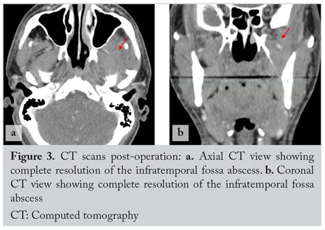 Infratemporal Fossa Abscess Drainage Via A Trans Oral Image Guided Approach Turkish Archives