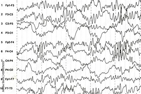 Brain Wave Patterns On Electroencephalogram Eeg Of The Pediatric Patients Problems In The