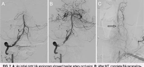 Figure 2 From Novel Use Of A Closed Tip Stent Retriever To Prevent Distal Embolism In The