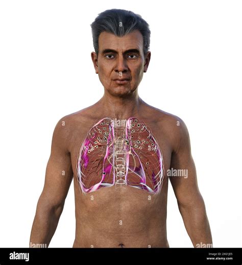 Illustration Of A Man With Lungs Affected By Silicosis Showing Dark Silicotic Nodules