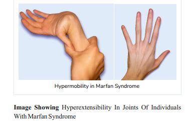 Syndrome De Marfan Mains Isaiah Austin Diagnosed With Marfan Syndrome