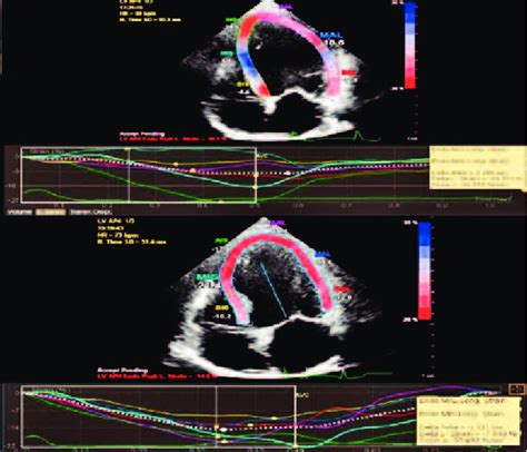 Figure Maximal Septal To Lateral Delay Before And After Cardiac