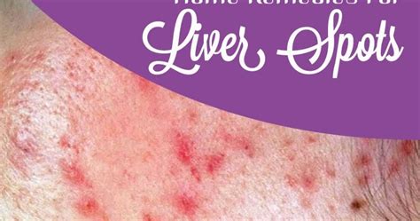Home Remedies For Liver Spots Tips Park