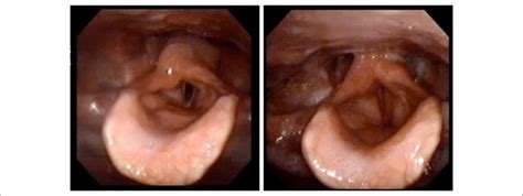 Videostroboscopy Showing A Patient With Glottic Gap On I Phonation