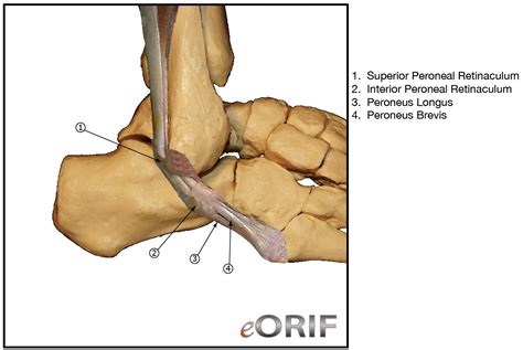 Peroneal Tendon Dislocation S86 399a 726 79 Eorif