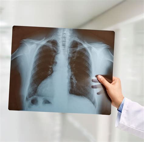 What Are The Latest Advancements In Lung Nodule Treatment Dr Mohan Venkatesh Pulle