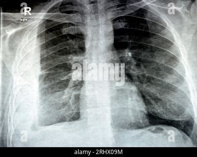 Plain X Ray For A Patient With Aspiration Pneumonia Right Lung Empyema
