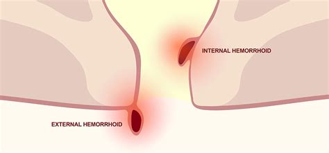 Internal Hemorrhoids Bleeding During Bowel Movement