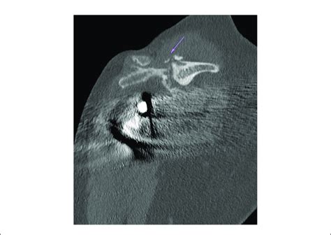 Scapular Spine Fracture Purple Arrow In Lateralized Rsa Global Download Scientific Diagram