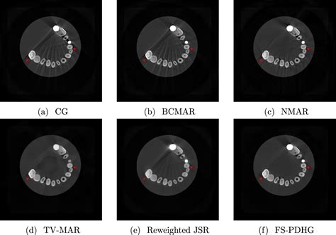 Nonconvex Weighted Variational Metal Artifacts Removal Via Convergent Primal Dual Algorithms