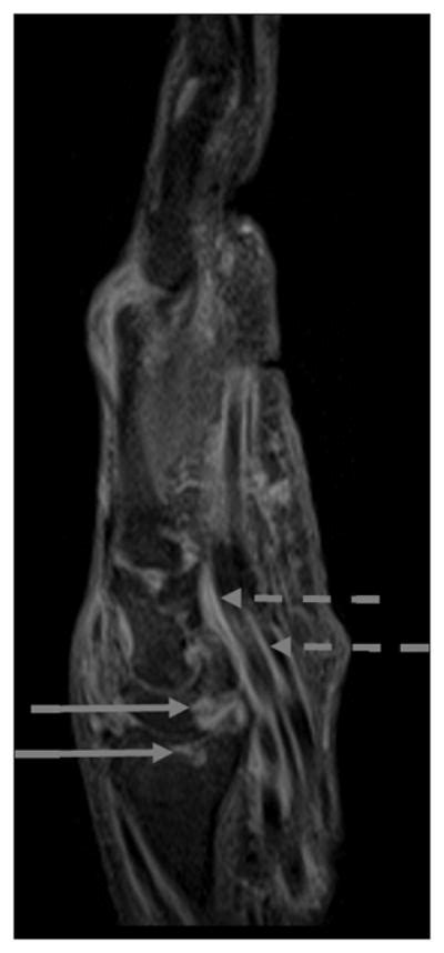 Diffuse Palpable Tendon Friction Rubs In A Patient With Seronegative Erosive Polyarthritis Pmc