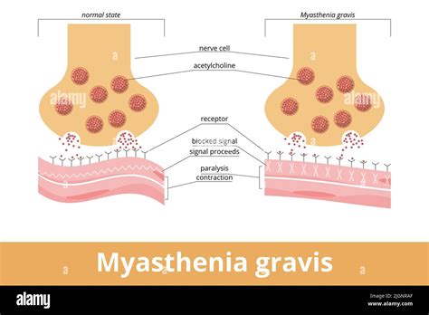 Miastenia grave Enfermedad autoinmune de la unión neuromuscular cuando