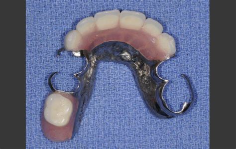 Removable Partial Dentures Removable Partial Dentures