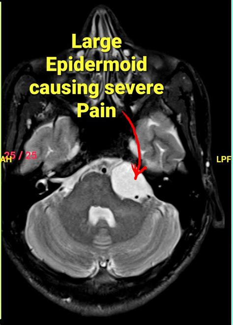 Blog Trigeminal Neuralgia Treatment