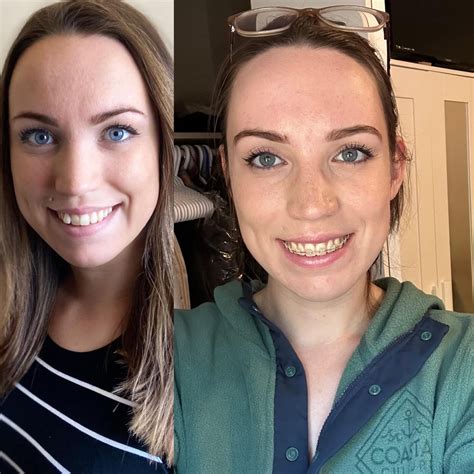 Adult Braces Progress R Braces