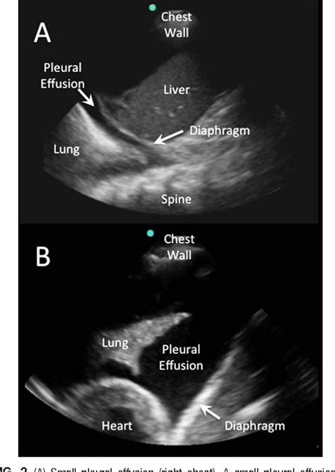 Pleural Effusion Ultrasound