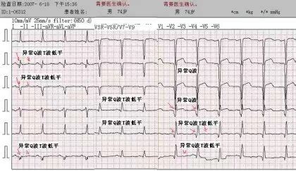 另类心电图讲义 12 心肌梗死心电图诊断（3）
