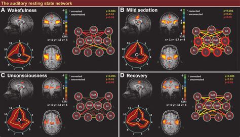 Auditory Resting State Network Rsn Integrity During Wakefulness Mild Download Scientific